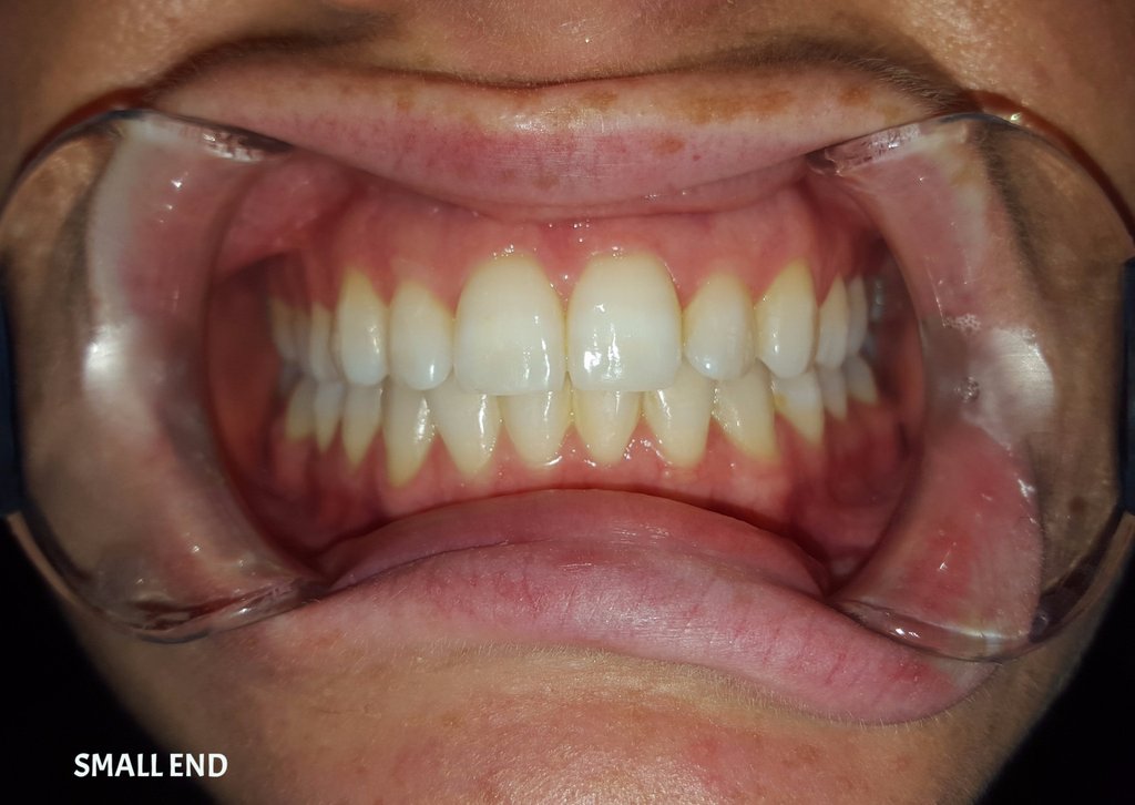 Plastic Double-Ended C & Y Cheek Retractor - Large (2 or 12 pack) – EOCA